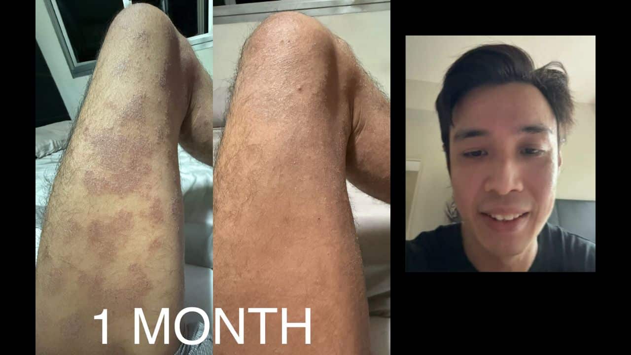 What Is TSW Skin? Darren's Journey Through Topical Steroid Withdrawal ...